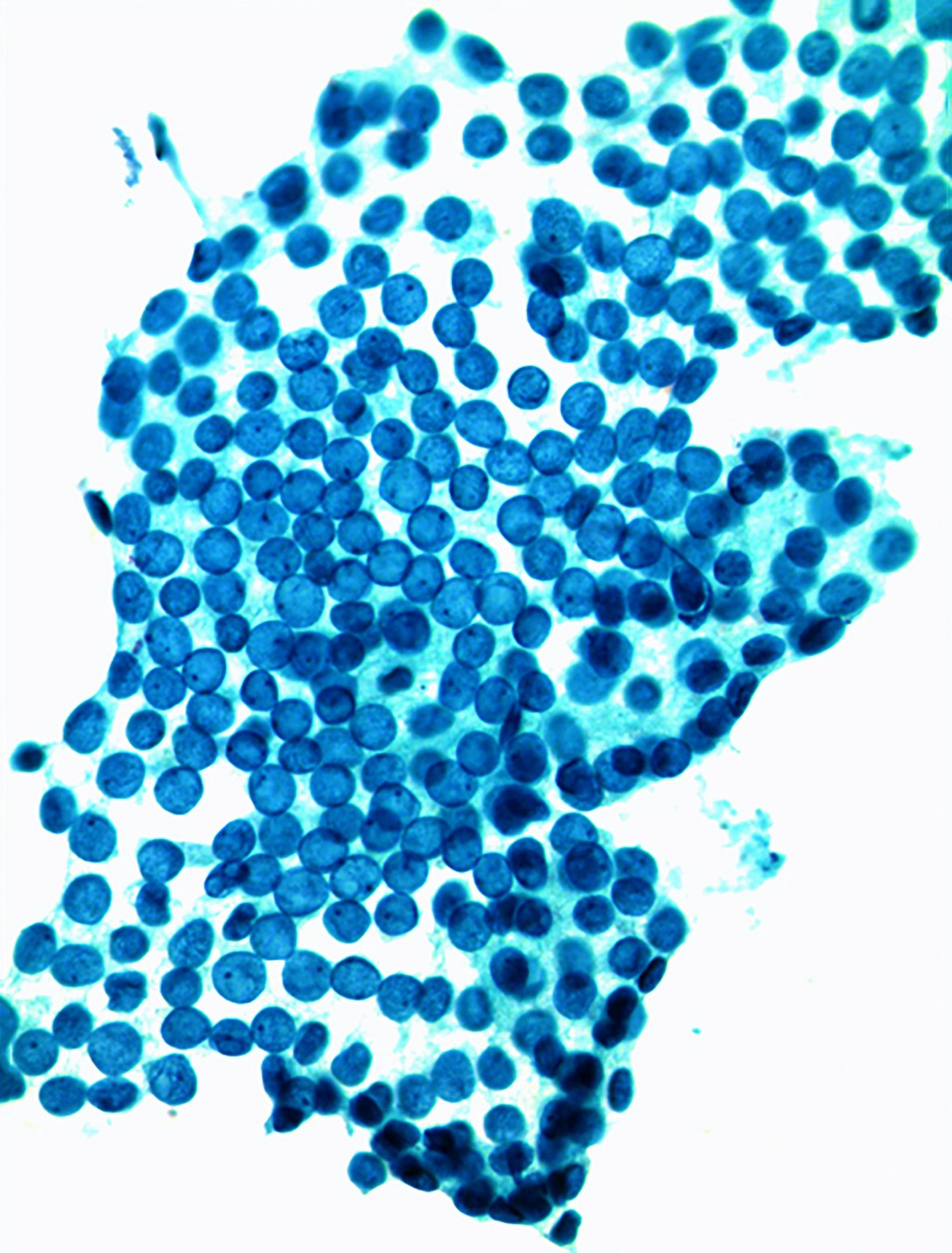 Benign Endometrial Cells in Women Over 40 Years of Age: What is the ...